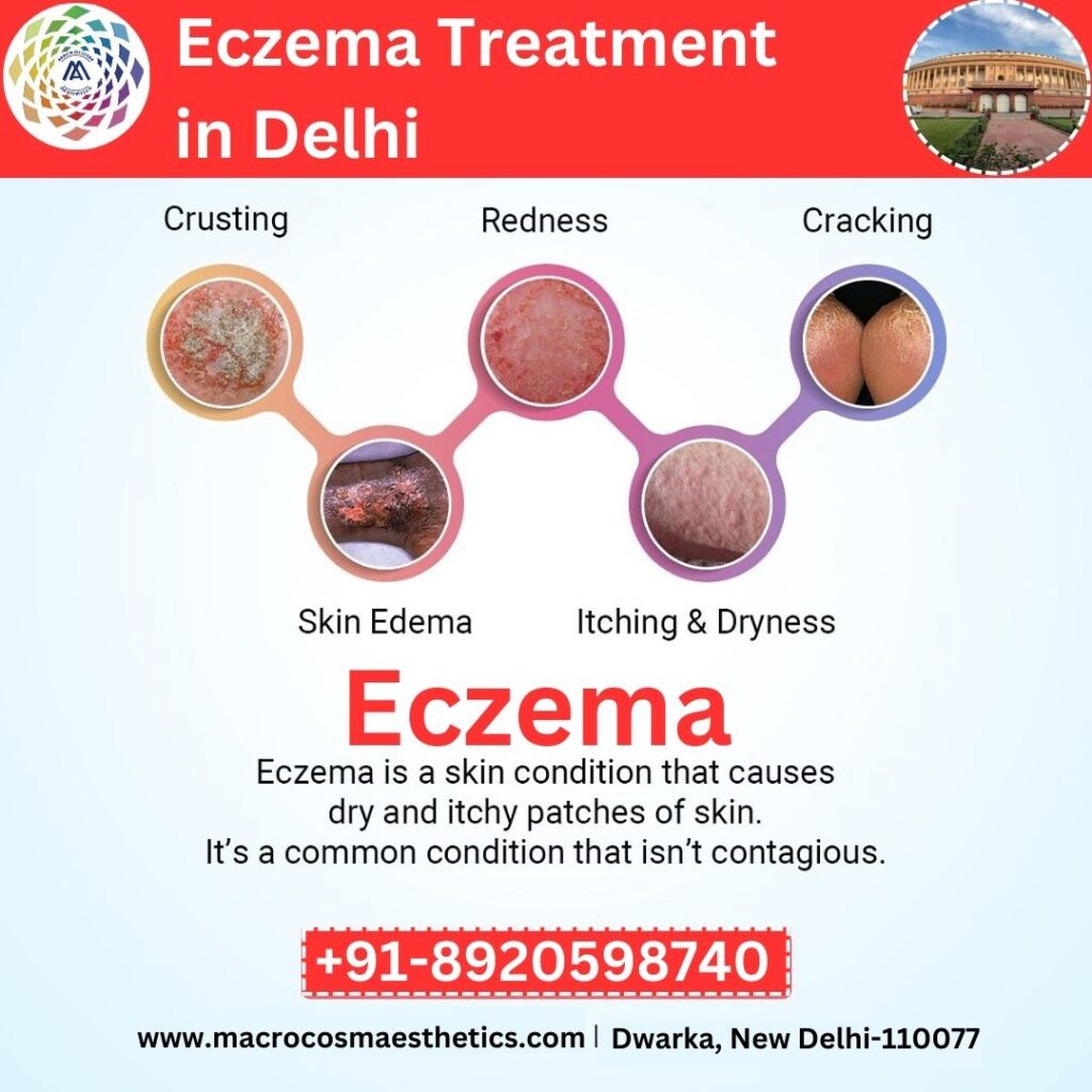 Eczema Treatment in Delhi